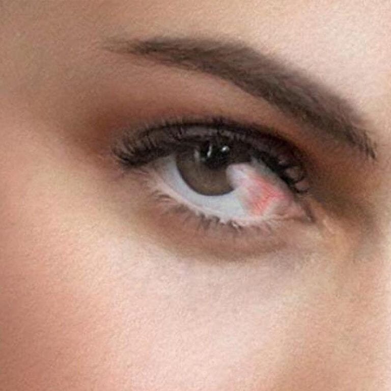 Cirurgia de Pterígio – H. Olhos Santarém/PA